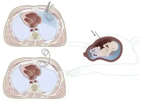 Fetal Shunt Insertion – Bladder & Thorax | Fetal India
